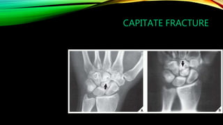 X ray of wrist and hand | PPTX