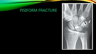 X ray of wrist and hand | PPTX