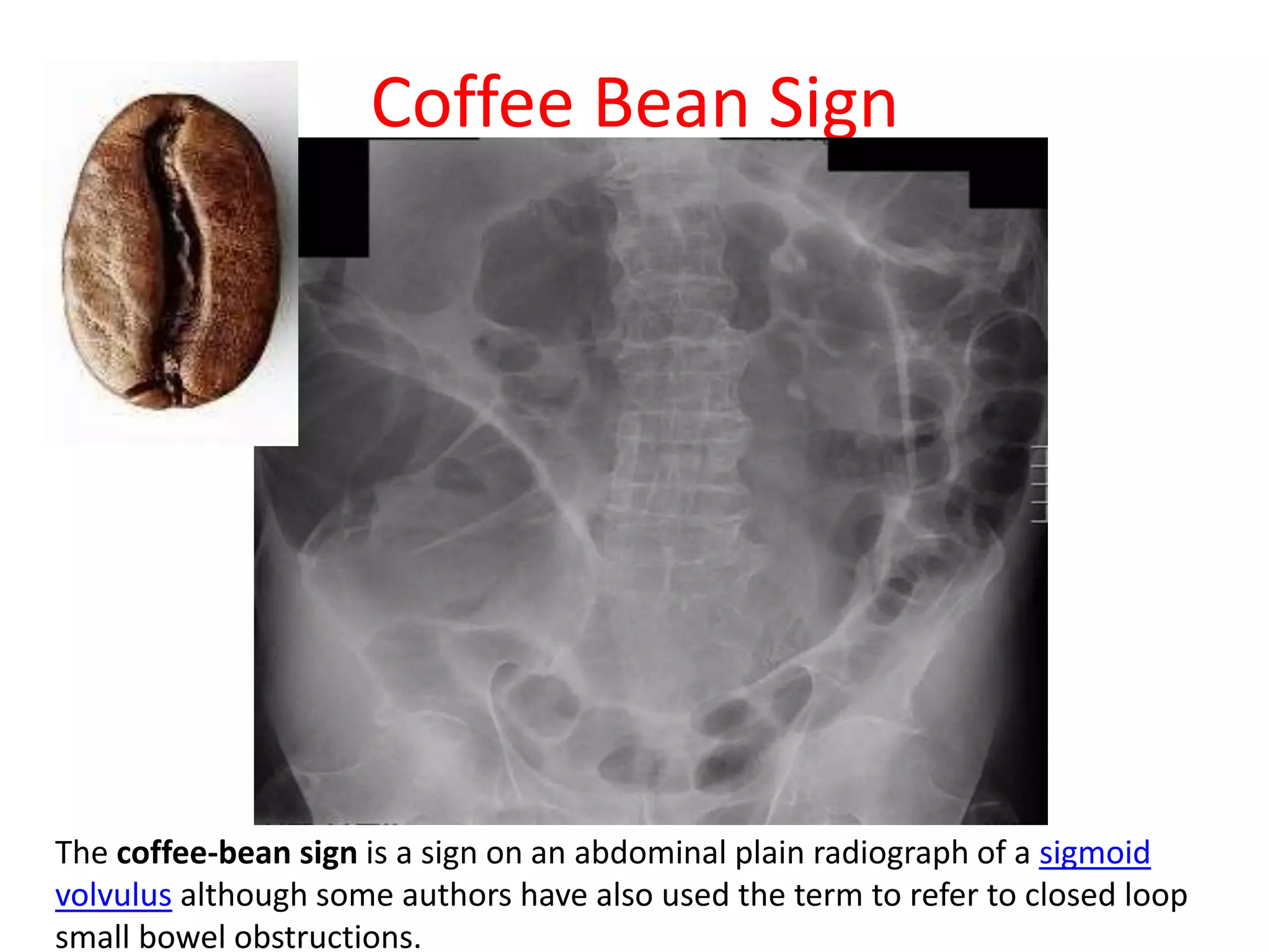 X ray signs of abdomen | PPTX