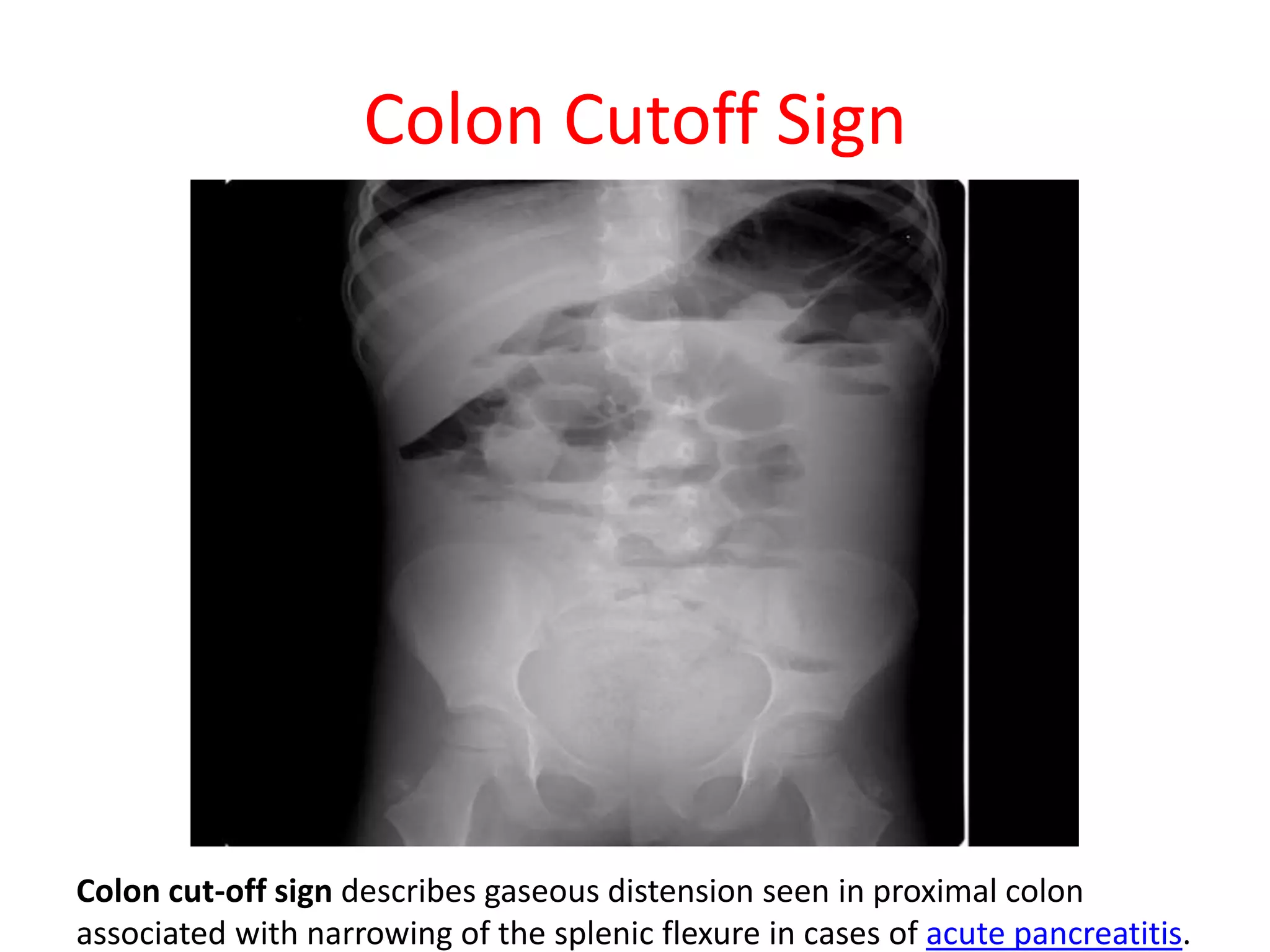X ray signs of abdomen | PPTX