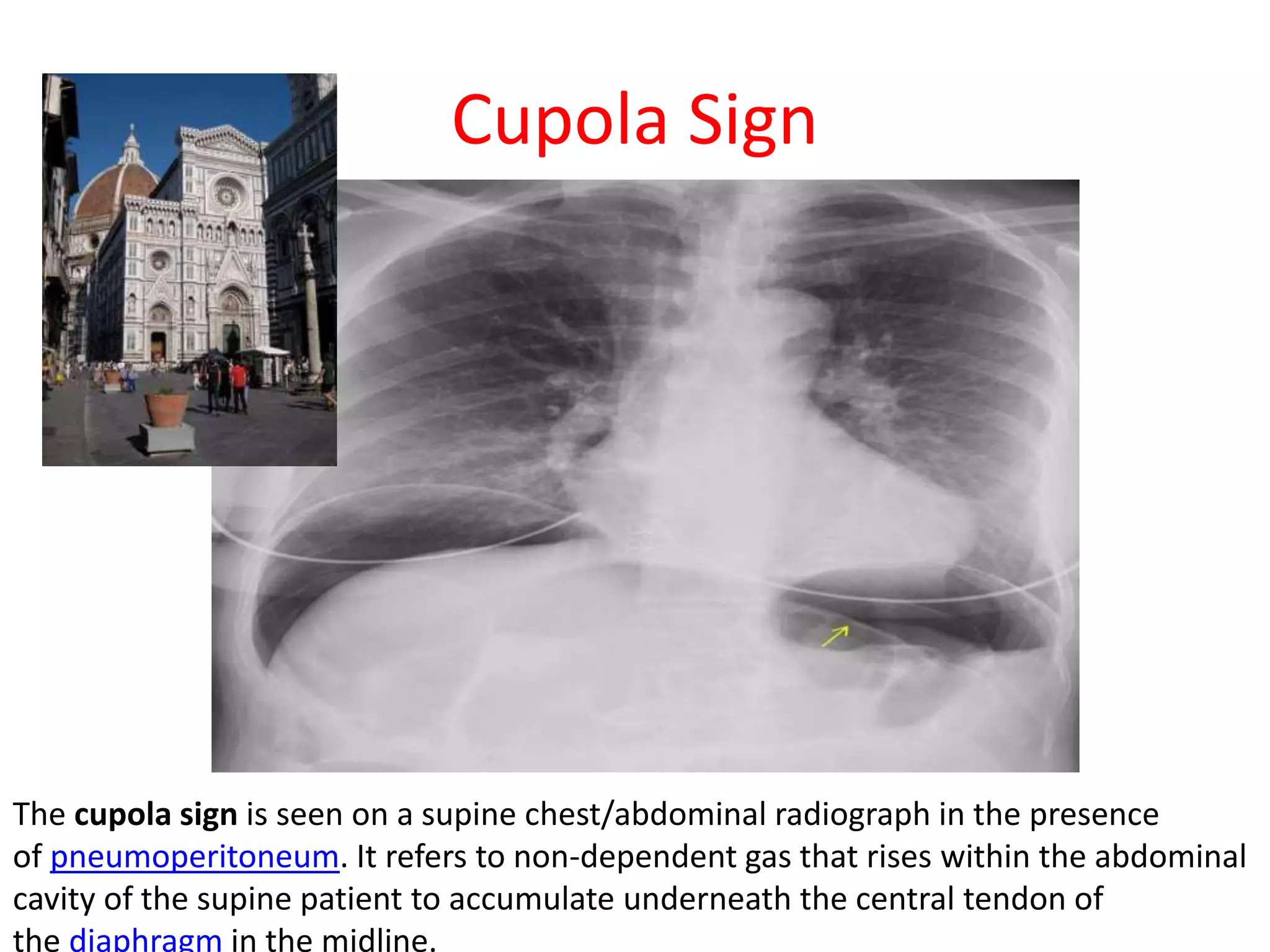 X ray signs of abdomen | PPTX
