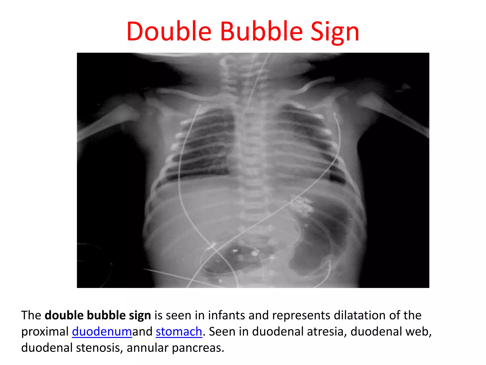 X ray signs of abdomen | PPTX