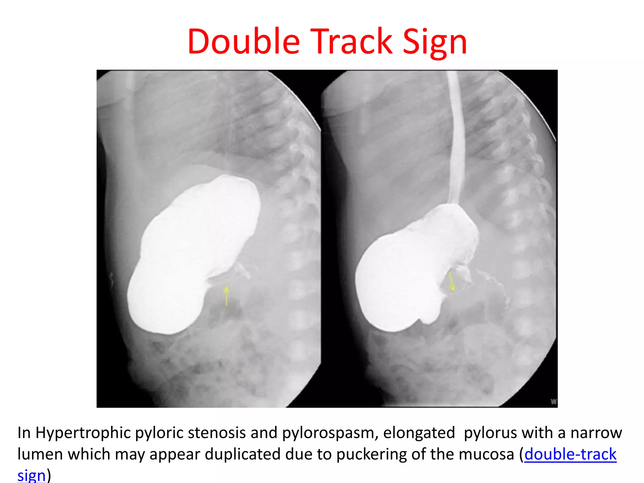 X ray signs of abdomen | PPTX