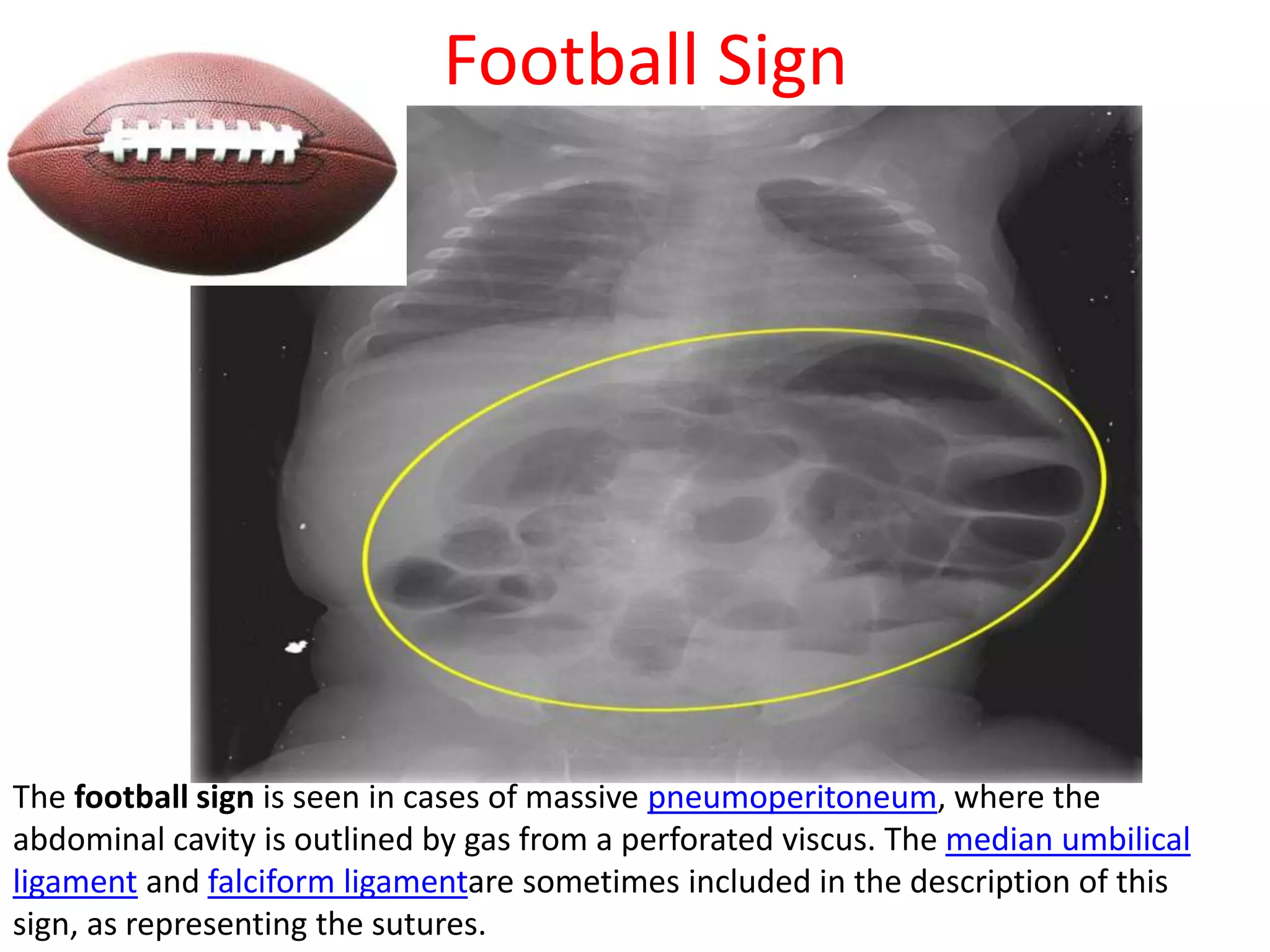 X ray signs of abdomen | PPTX