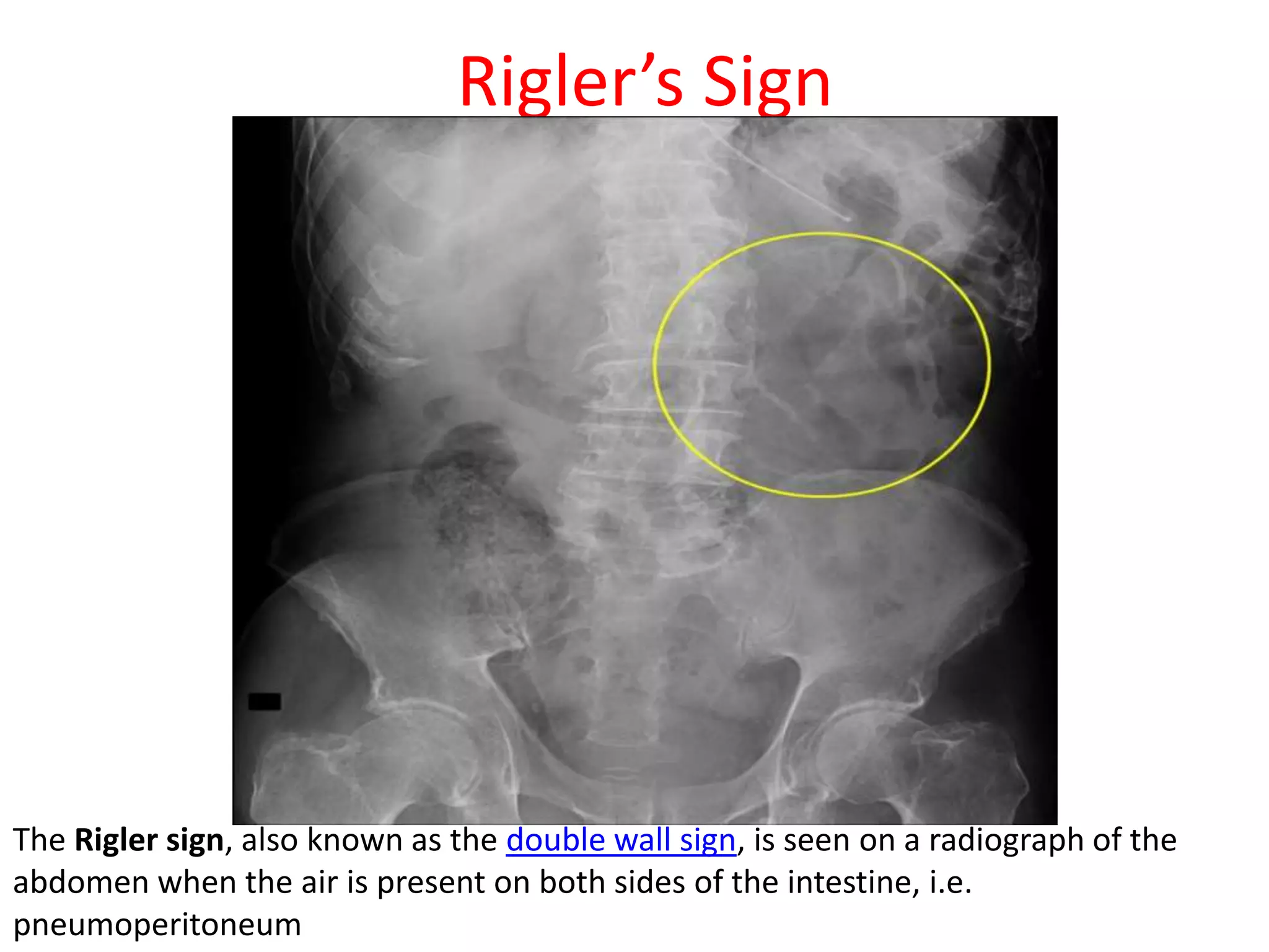 X ray signs of abdomen | PPTX