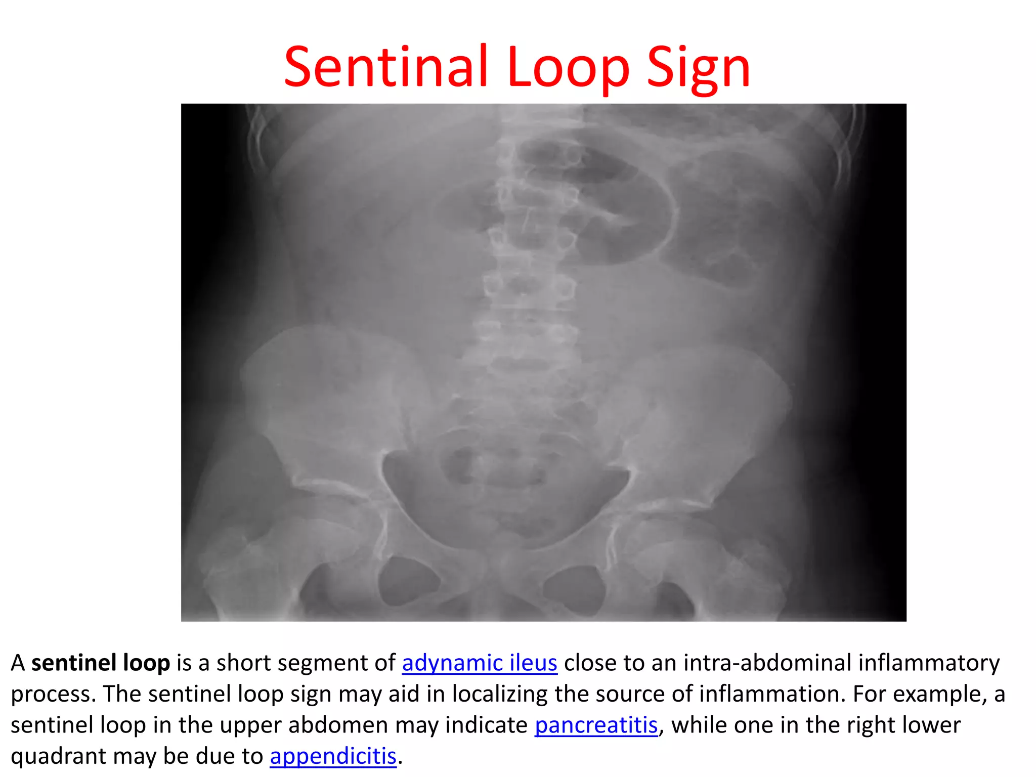 X ray signs of abdomen | PPTX