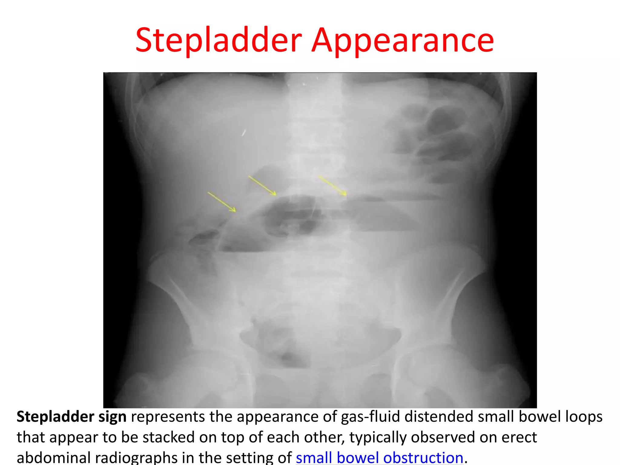 X ray signs of abdomen | PPTX