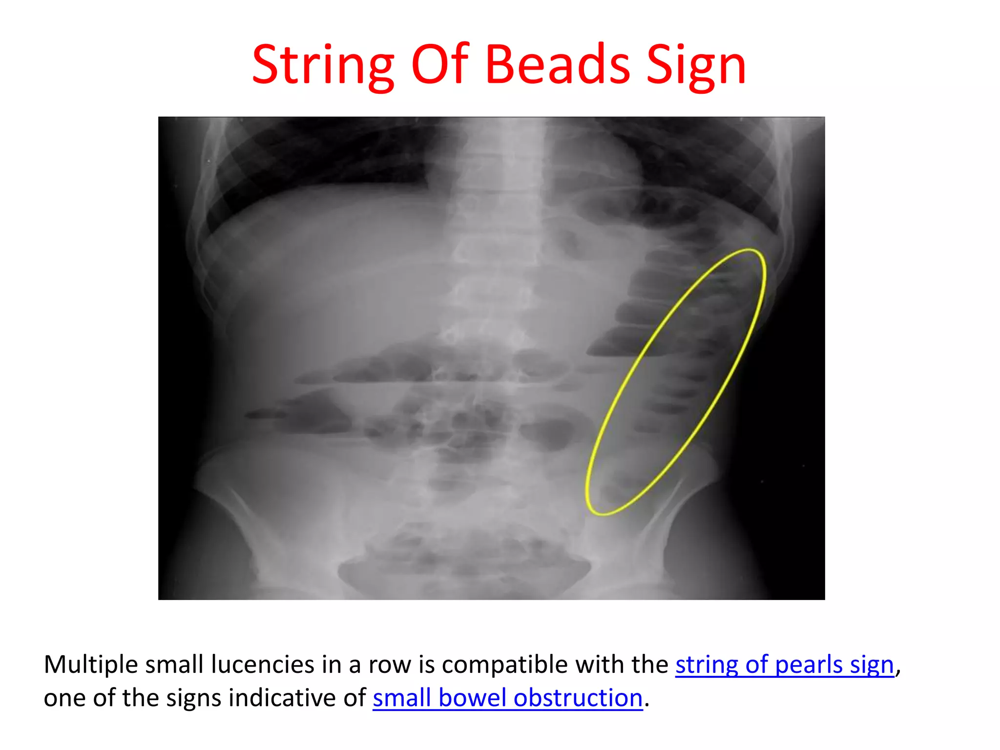 X ray signs of abdomen | PPTX