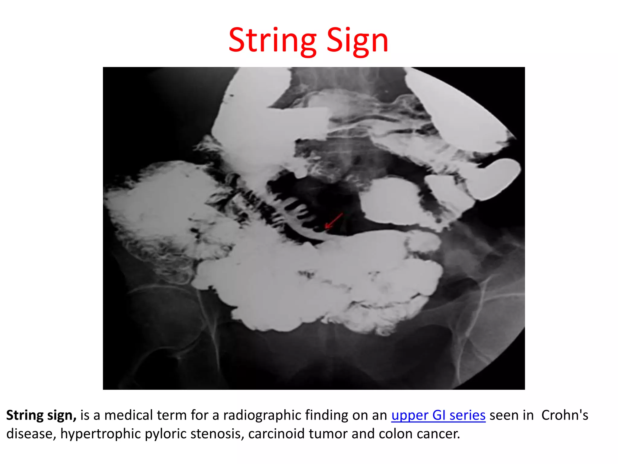X ray signs of abdomen | PPTX