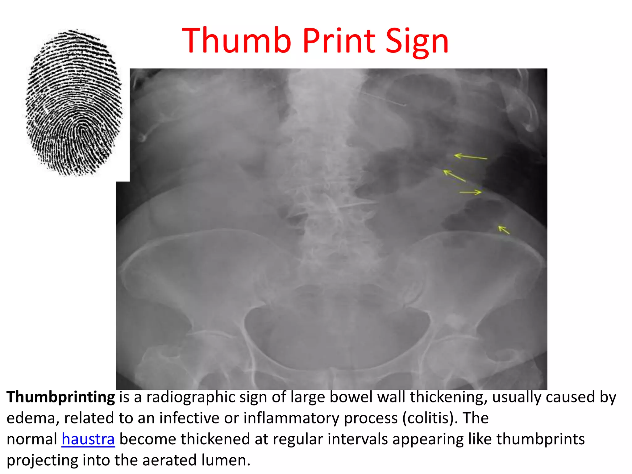 X ray signs of abdomen | PPTX