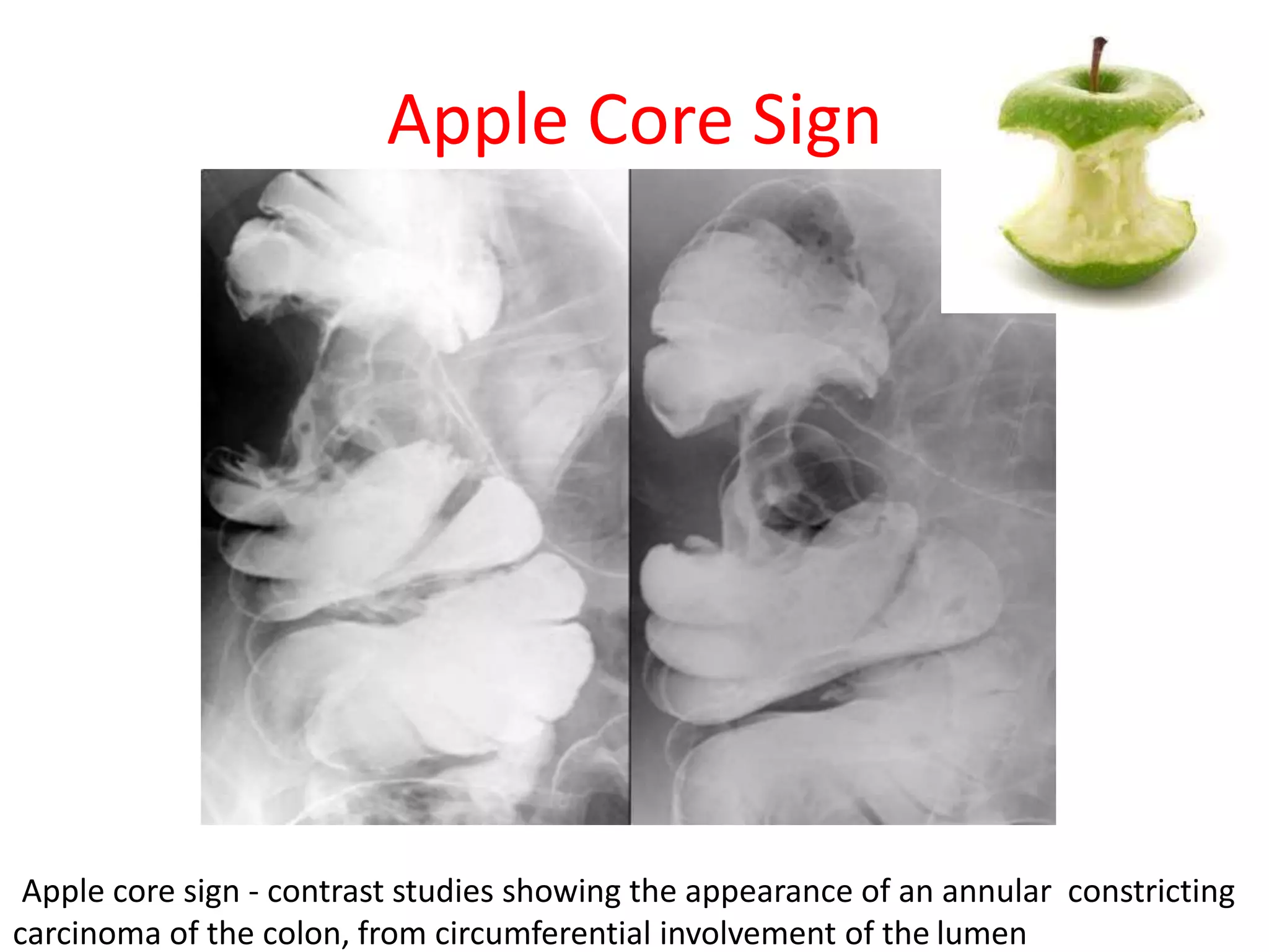 X ray signs of abdomen | PPTX