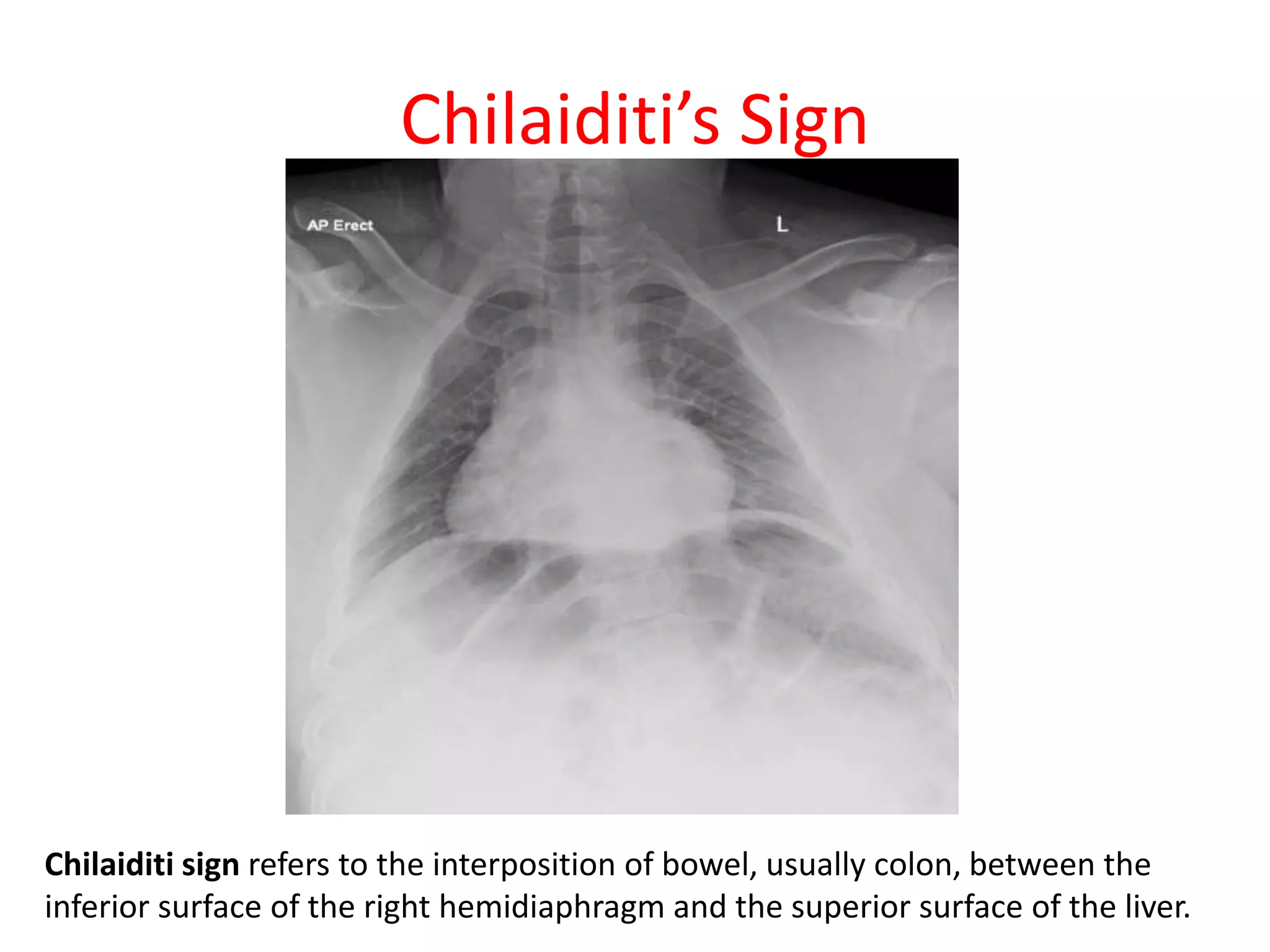 X ray signs of abdomen | PPTX