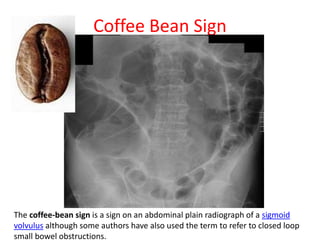 X ray signs of abdomen | PPTX