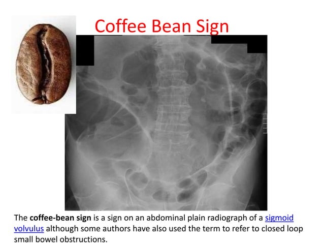 X ray signs of abdomen | PPTX | Digestive Disorders | Diseases and ...