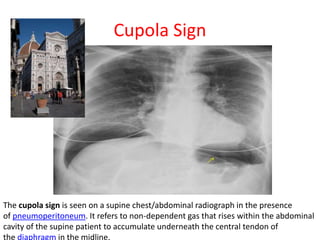 X ray signs of abdomen | PPTX