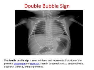 X ray signs of abdomen | PPTX