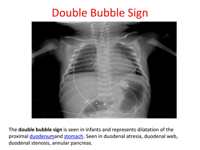 X ray signs of abdomen | PPTX | Digestive Disorders | Diseases and ...