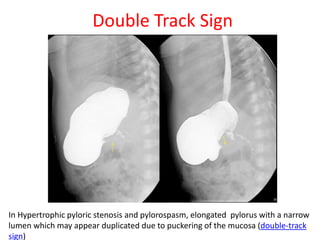 X ray signs of abdomen | PPTX