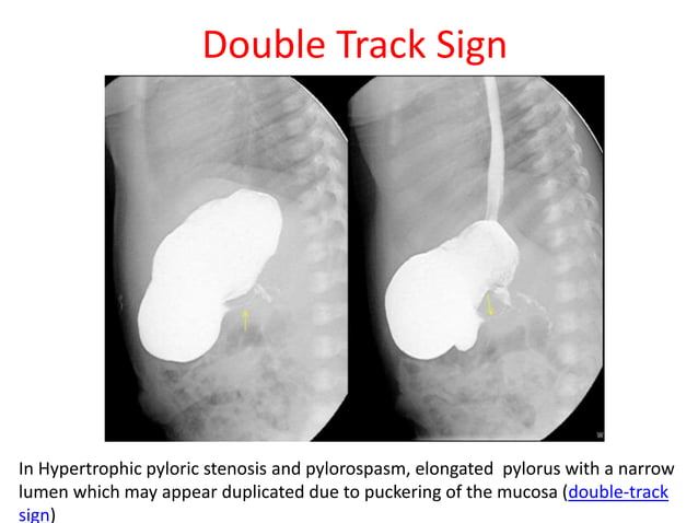 X ray signs of abdomen | PPTX | Digestive Disorders | Diseases and ...