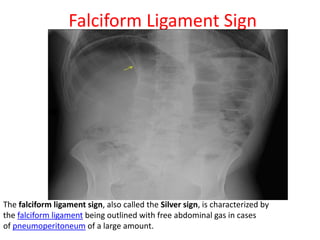 X ray signs of abdomen | PPTX
