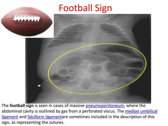 X ray signs of abdomen | PPTX | Digestive Disorders | Diseases and ...