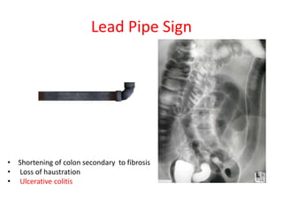 X ray signs of abdomen | PPTX