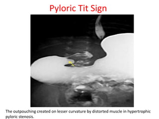 X ray signs of abdomen | PPTX