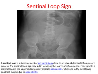 X ray signs of abdomen | PPTX | Digestive Disorders | Diseases and ...