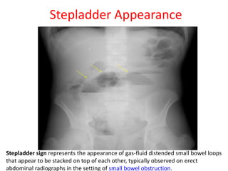 X ray signs of abdomen | PPTX