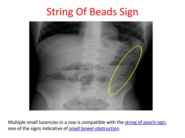 X ray signs of abdomen | PPTX | Digestive Disorders | Diseases and ...