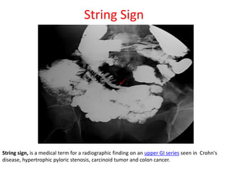 X ray signs of abdomen | PPTX | Digestive Disorders | Diseases and ...