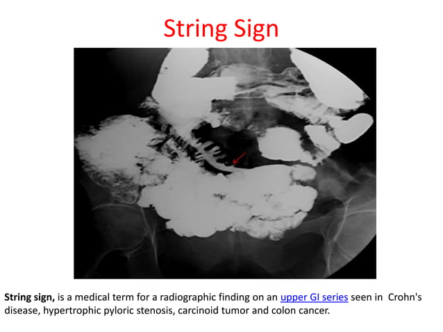 X ray signs of abdomen | PPTX | Digestive Disorders | Diseases and ...