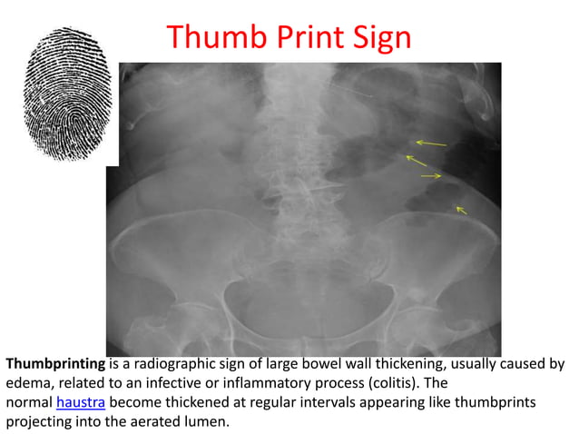 X ray signs of abdomen | PPTX | Digestive Disorders | Diseases and ...