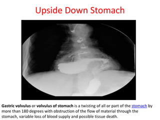 X ray signs of abdomen | PPTX