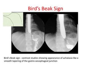 X ray signs of abdomen | PPTX