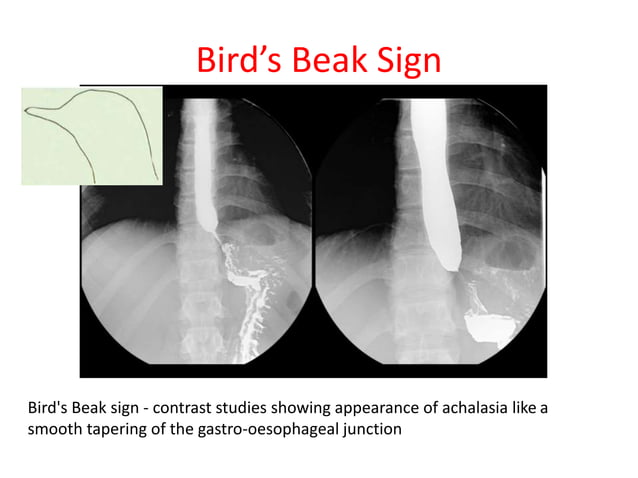 X ray signs of abdomen | PPTX | Digestive Disorders | Diseases and ...