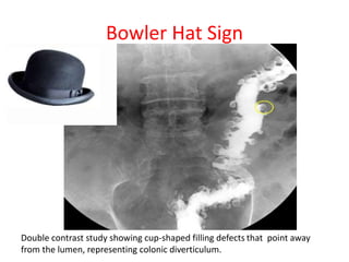 X ray signs of abdomen | PPTX