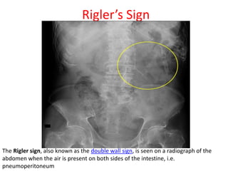 X ray signs of abdomen | PPT