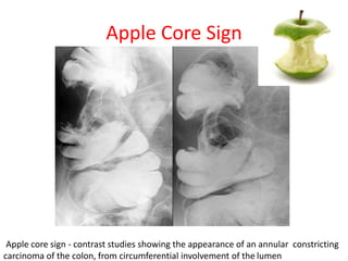 X ray signs of abdomen | PPT