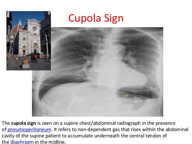 X ray signs of abdomen