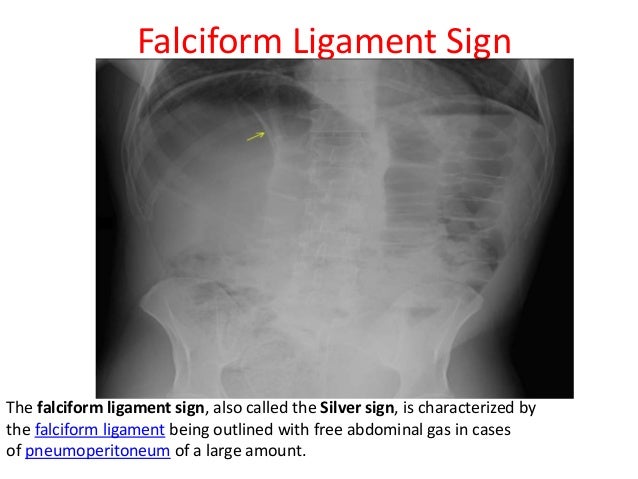 X ray signs of abdomen