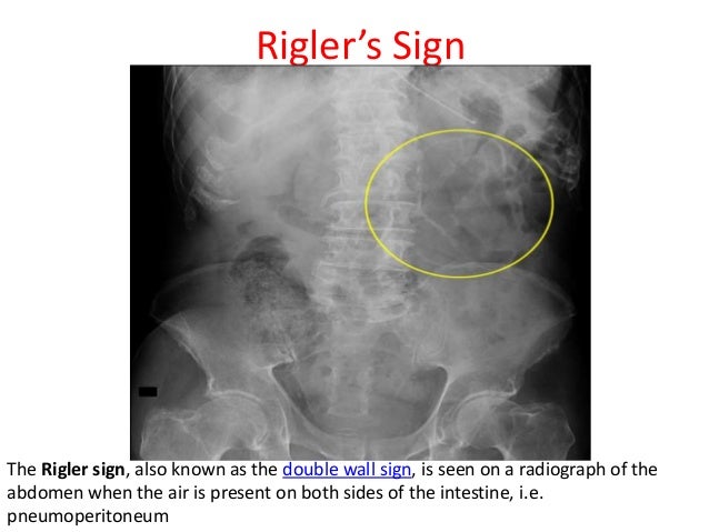 X ray signs of abdomen