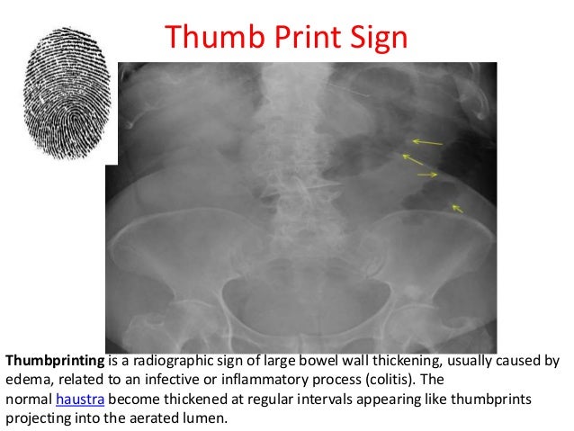 X ray signs of abdomen