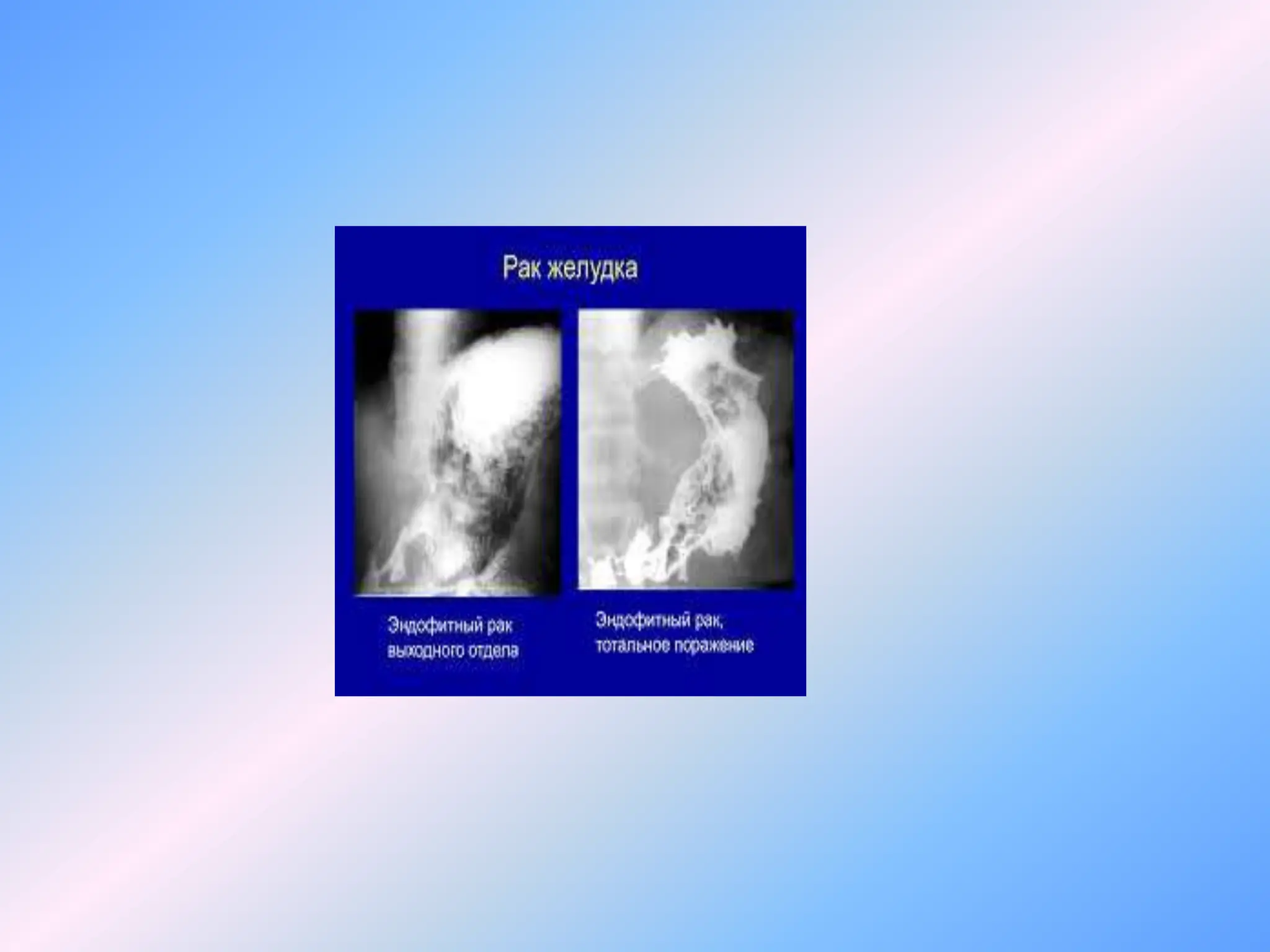 X-ray signs of gastrointestinal pathology.ppt