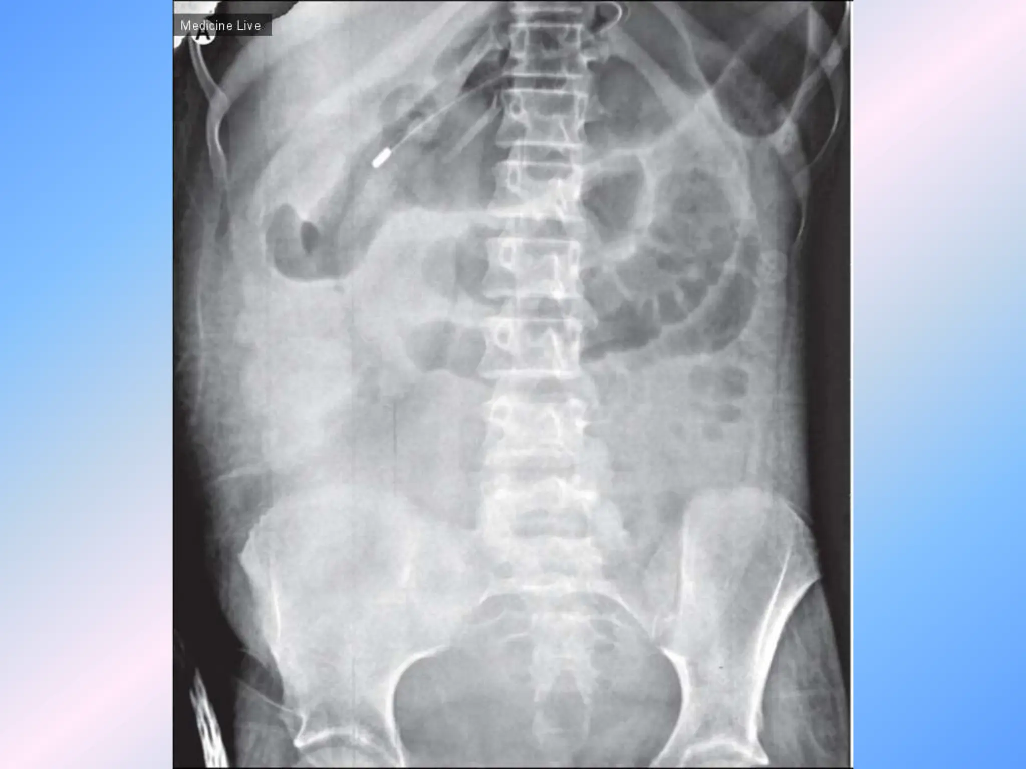 X-ray signs of gastrointestinal pathology.ppt