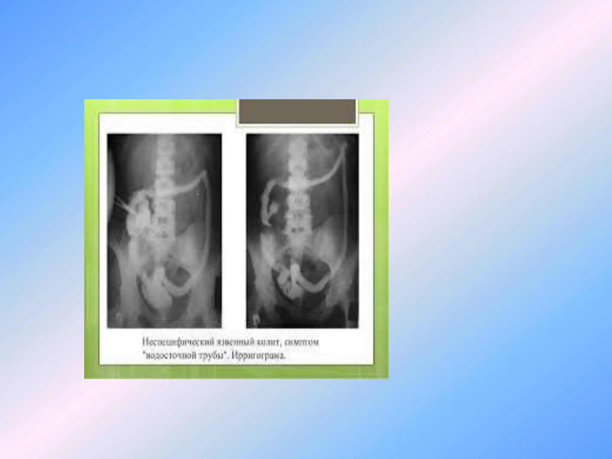X-ray signs of gastrointestinal pathology.ppt