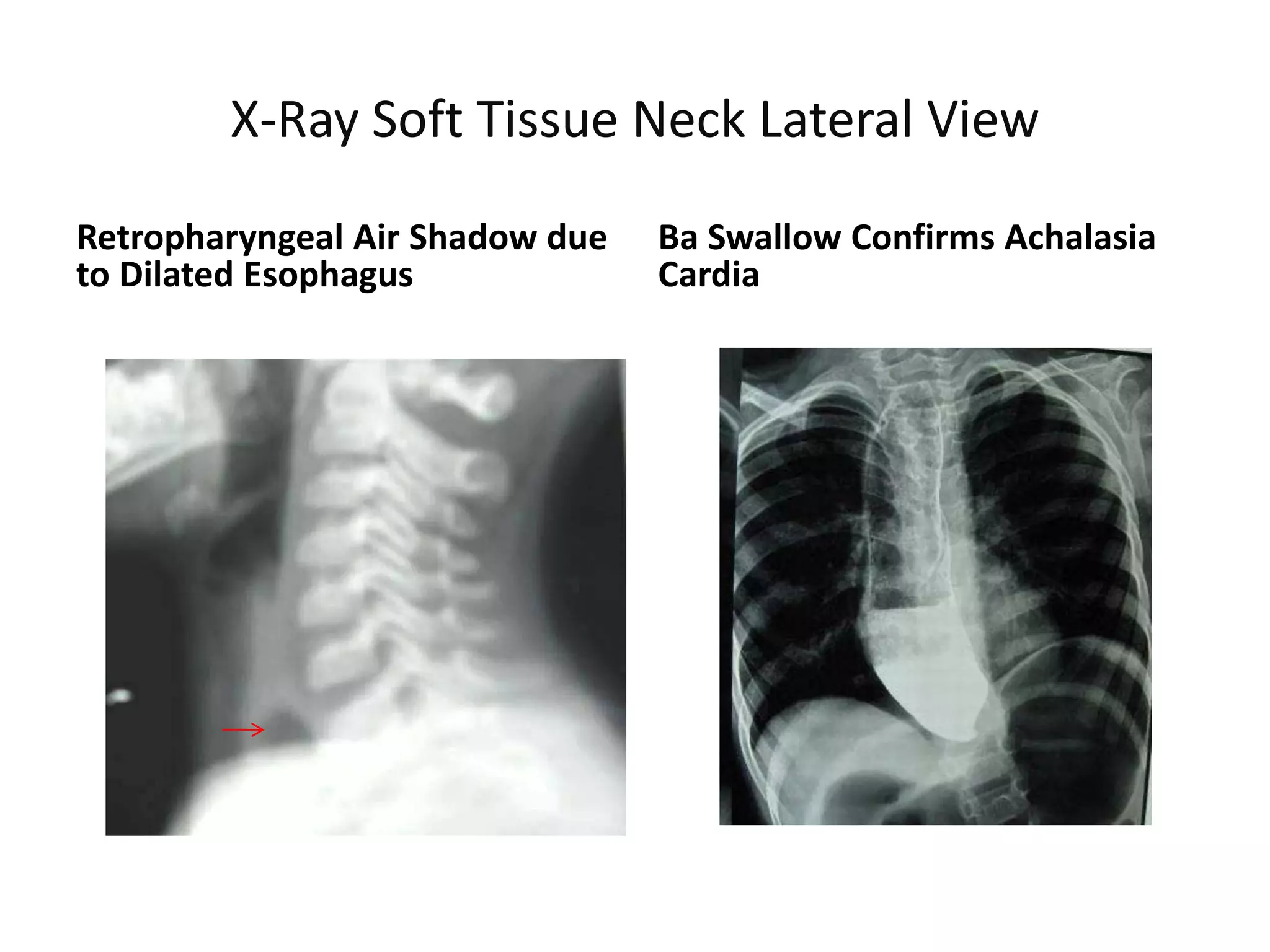 X ray soft tissue neck valuable economic tool | PPTX