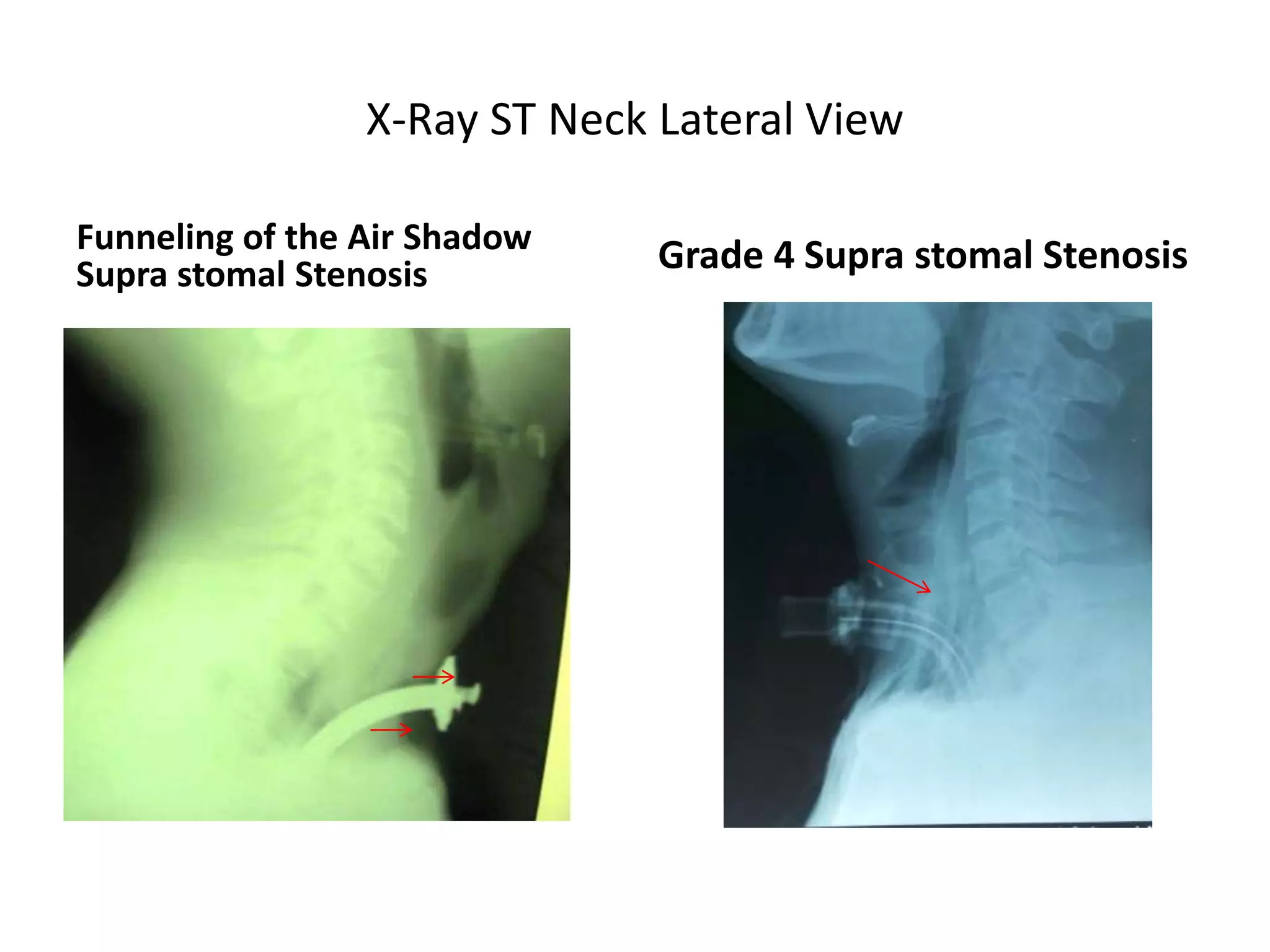 X ray soft tissue neck valuable economic tool | PPTX