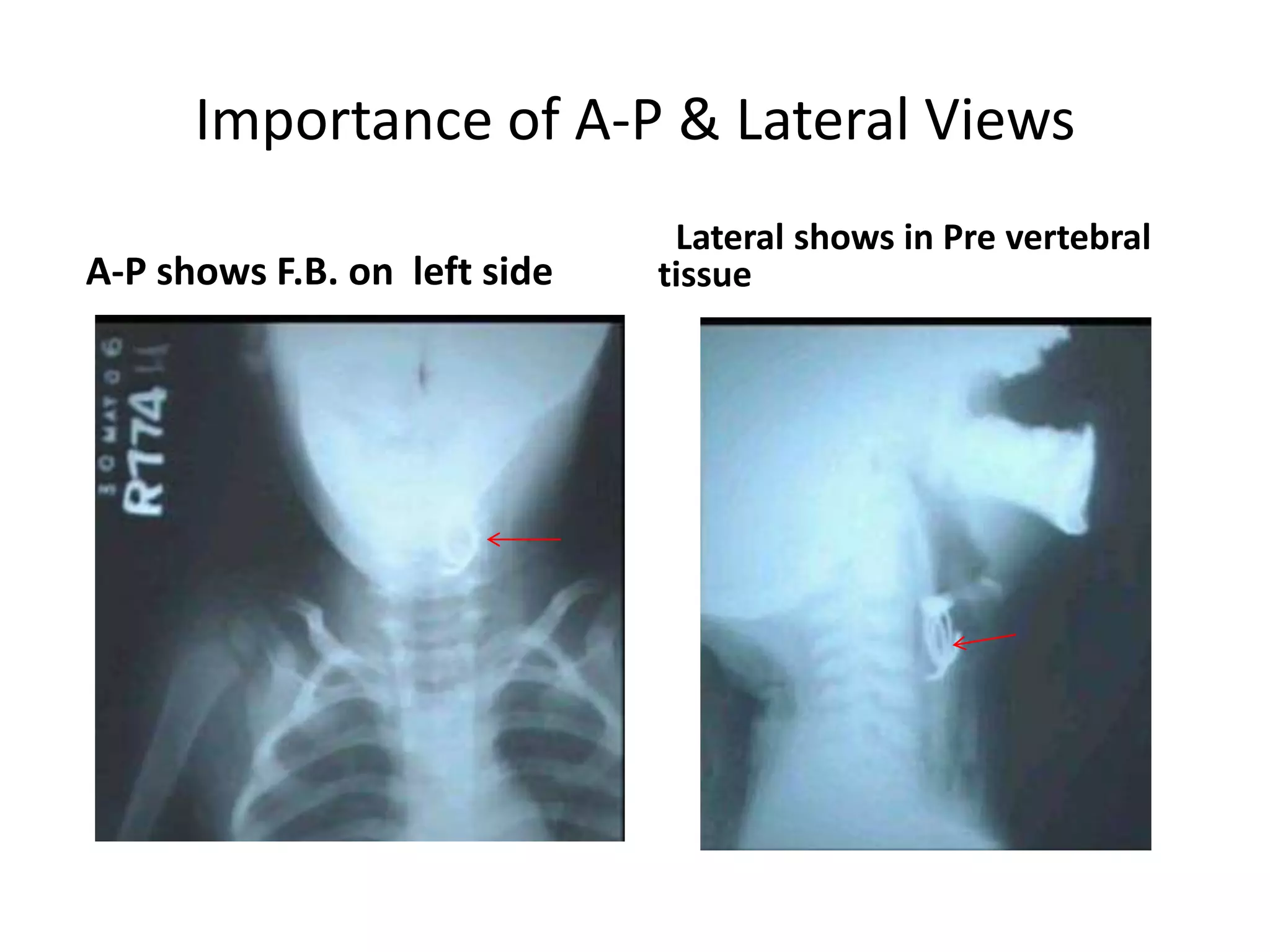 X ray soft tissue neck valuable economic tool | PPTX