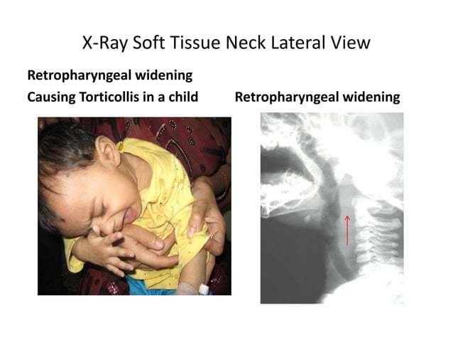 X ray soft tissue neck valuable economic tool | PPT